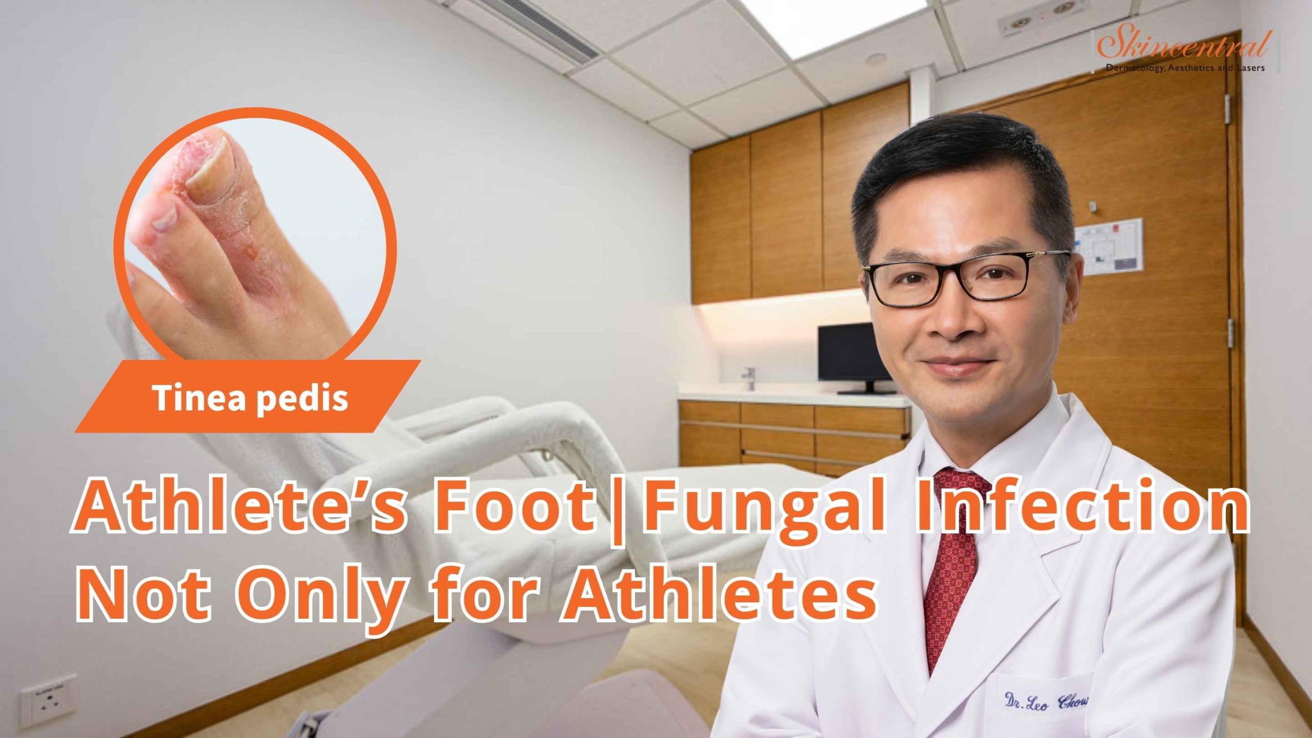 Athlete’s Foot | Fungal Infection is not limited to just athletes!